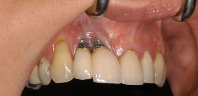 Diagnosing Between ailing and failing of dental implants ...